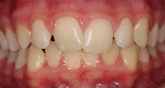 Patient: Juliana - Kadar Orthodontics